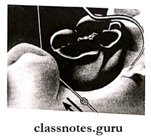 Pediatric Restorative Dentistry Question And Answers - Class Notes