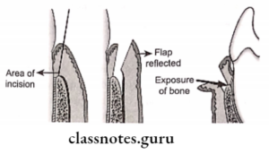 Periodontal Flap - Class Notes