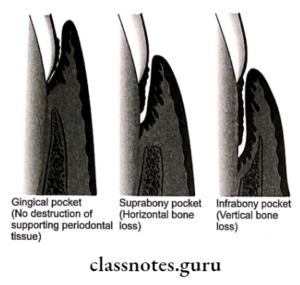 Periodontal Pocket Short And Long Essay Question And Answers - Class Notes
