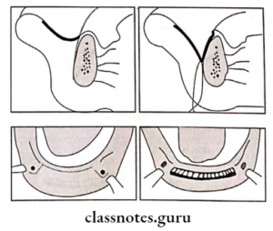 Pre Prosthetic Surgery - Class Notes