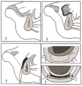 Pre Prosthetic Surgery - Class Notes