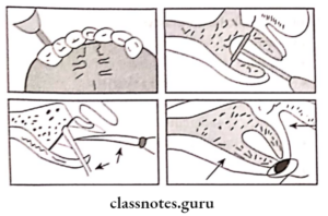 Pre Prosthetic Surgery - Class Notes
