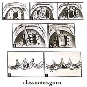 Pre Prosthetic Surgery - Class Notes
