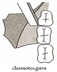 Maxilofacial Surgery Archives - Class Notes