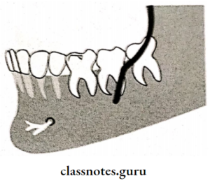 Maxilofacial Surgery Archives - Class Notes