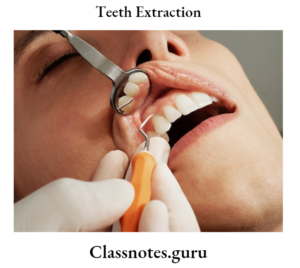 Teeth Extraction - Class Notes