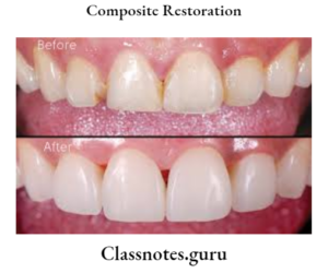 Composite Restoration Question And Answers - Class Notes