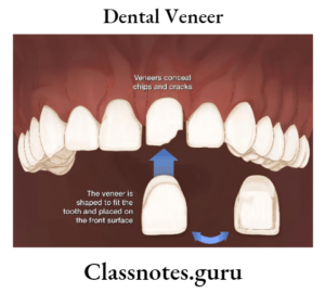 Dental Veneer Question And Answers - Class Notes