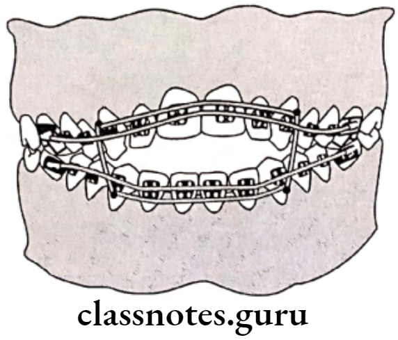 Fixed Appliances in Orthodontics Question And Answers - Class Notes