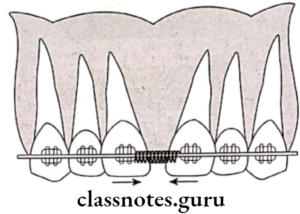 Fixed Appliances in Orthodontics Question And Answers - Class Notes