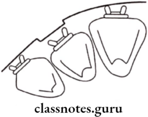 Fixed Appliances in Orthodontics Question And Answers - Class Notes