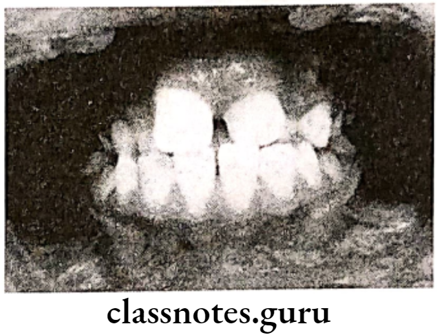 Management Of Malocclusion Orthodontics Question And Answers - Class Notes