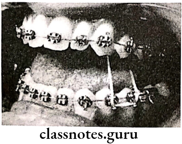 Management Of Malocclusion Orthodontics Question And Answers - Class Notes