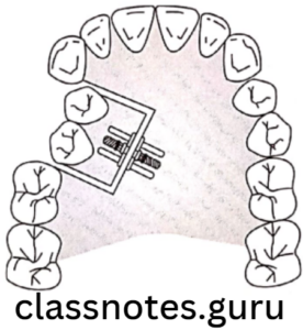 Removable Orthodontic Appliance Question And Answers - Class Notes
