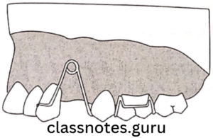 Removable Orthodontic Appliance Question And Answers - Class Notes