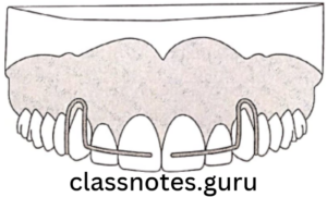 Removable Orthodontic Appliance Question And Answers - Class Notes