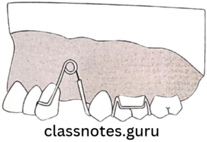 Removable Orthodontic Appliance Question And Answers - Class Notes