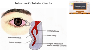 Nasal Conchae: Anatomy, Structure And Function Notes - Class Notes