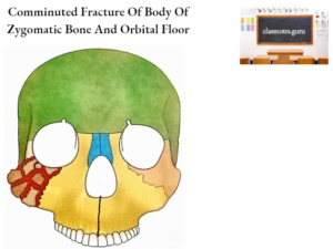 Zygomatic Bones Osteology Notes - Class Notes