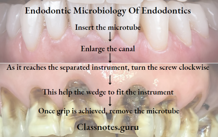 Endodontics Miscellaneous Question And Answers - Class Notes